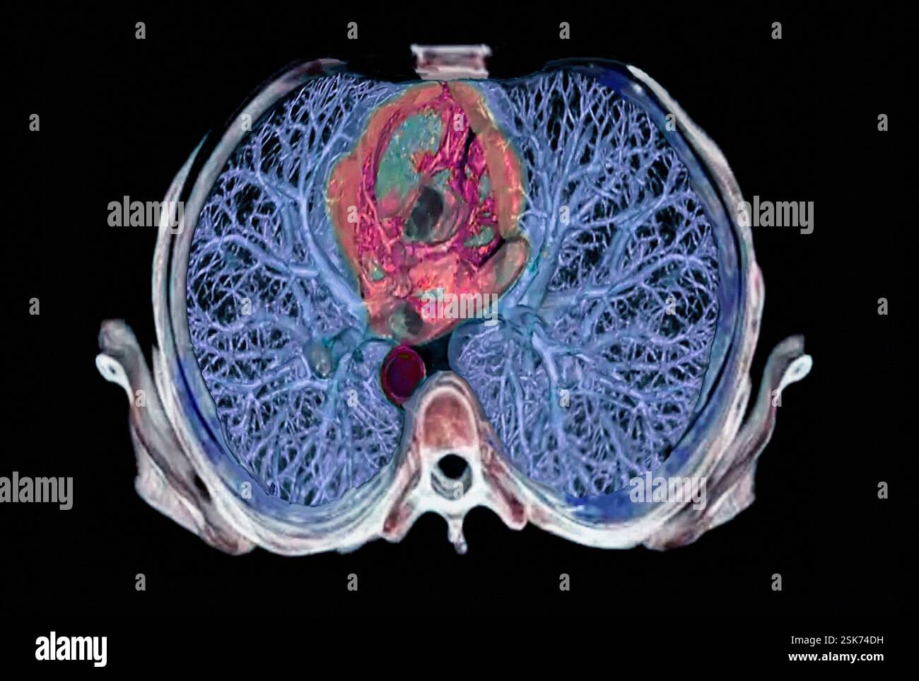 Healthy lungs. Coloured 3D computed tomography (CT) scan of the chest of a 47 year old male ...