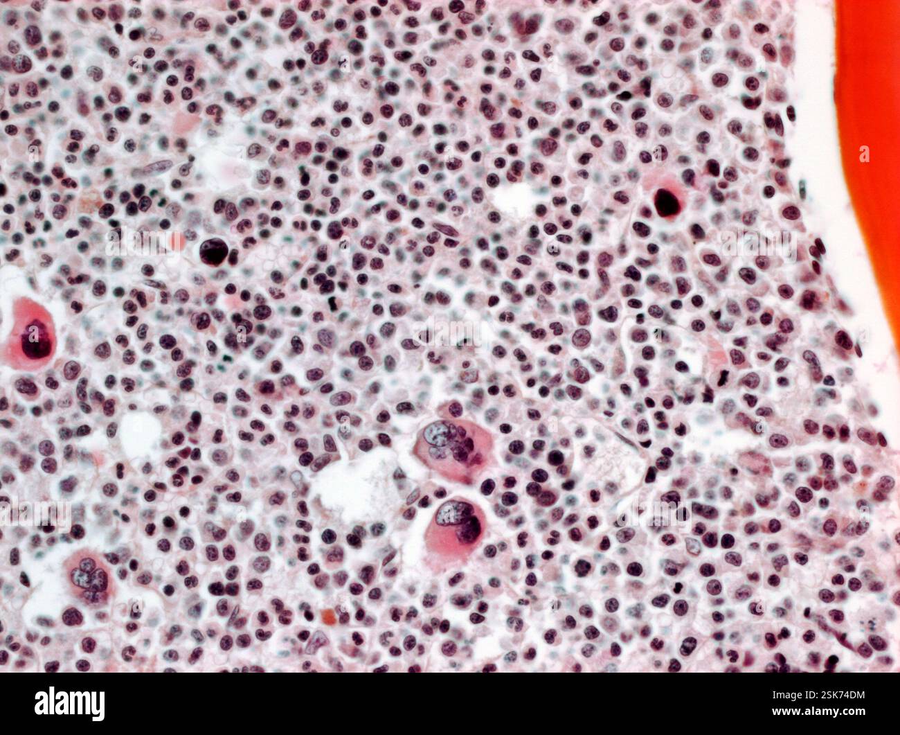 Myelodysplasia. light micrograph of a section through human bone marrow ...