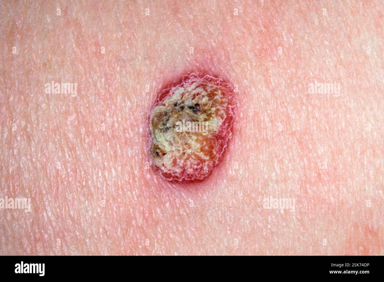 Bowen's disease of the skin. This is an early form of skin cancer that ...