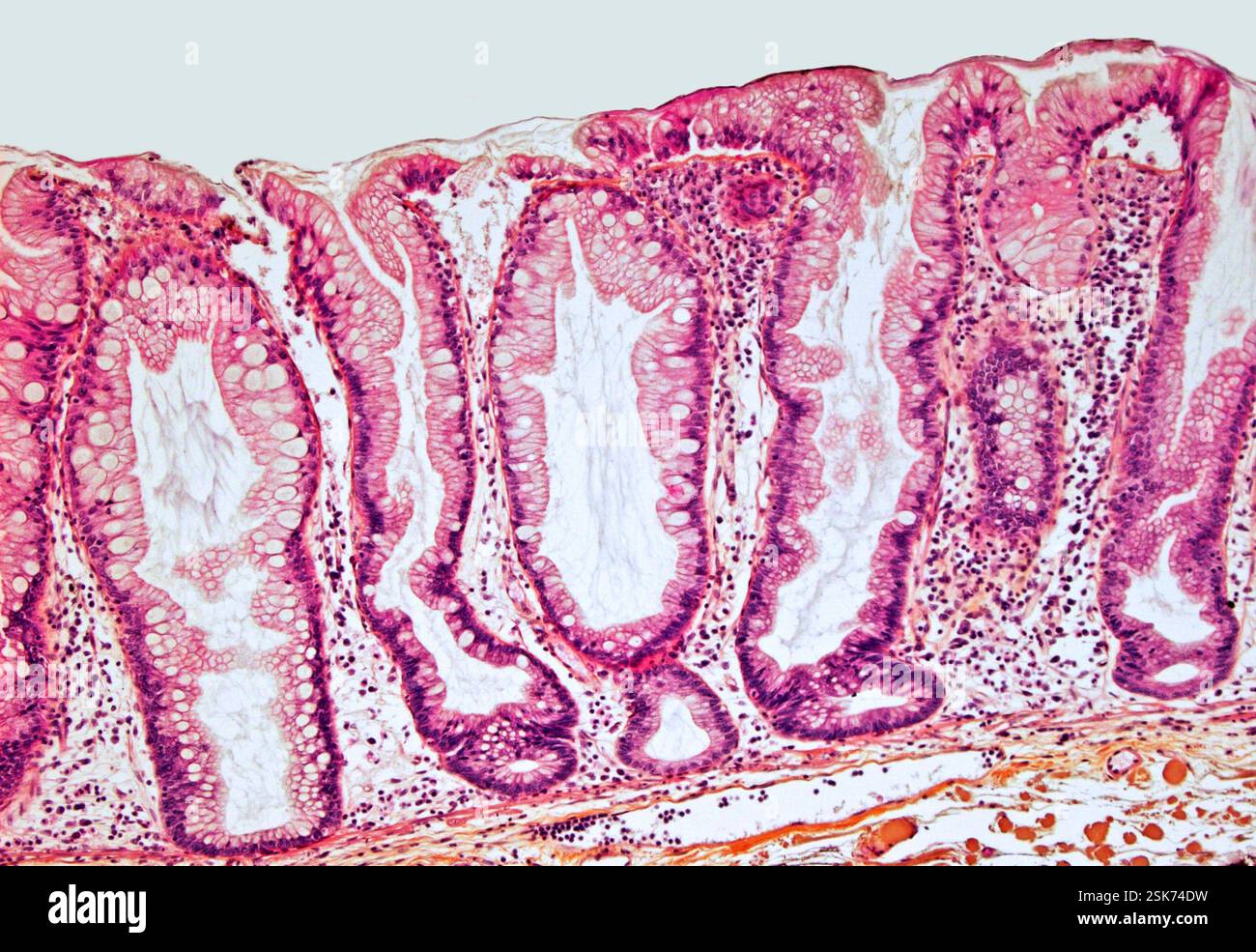 Colon cancer. Light micrograph of a section through an adenocarcinoma ...