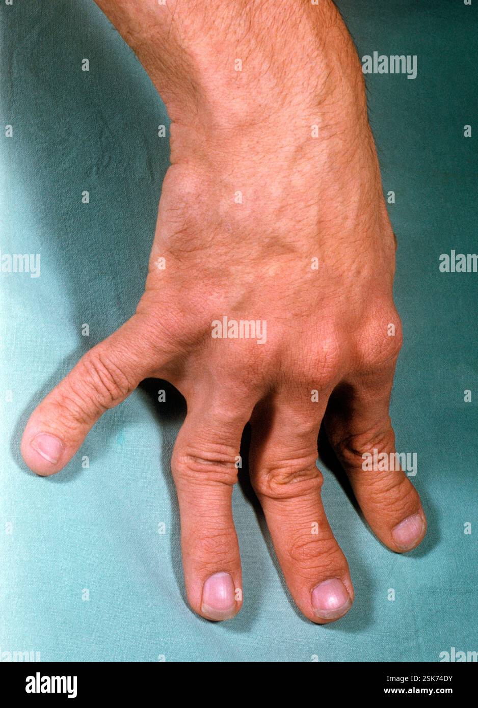 Ehlers-Danlos syndrome (EDS). Male patient with EDS demonstrating ...