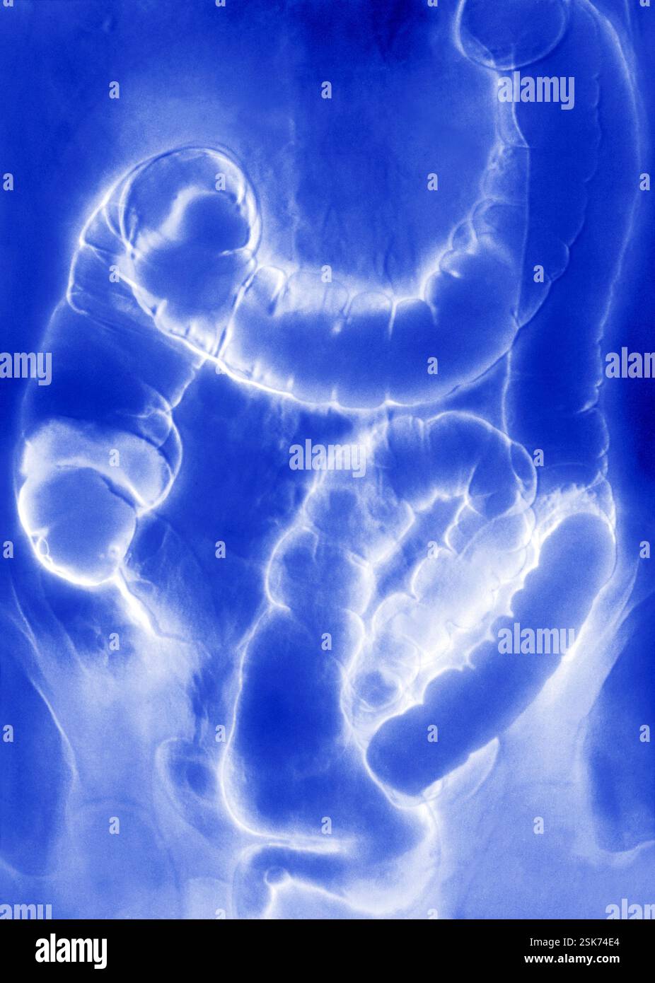 Healthy colon. Coloured frontal X-ray of a healthy colon (large ...