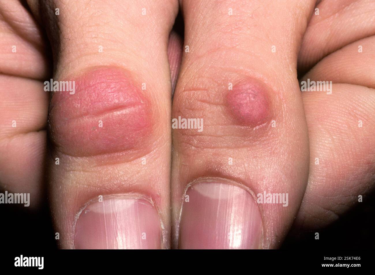 Knuckle pads, or Garrod's pads, on a patient's thumbs. These are benign ...