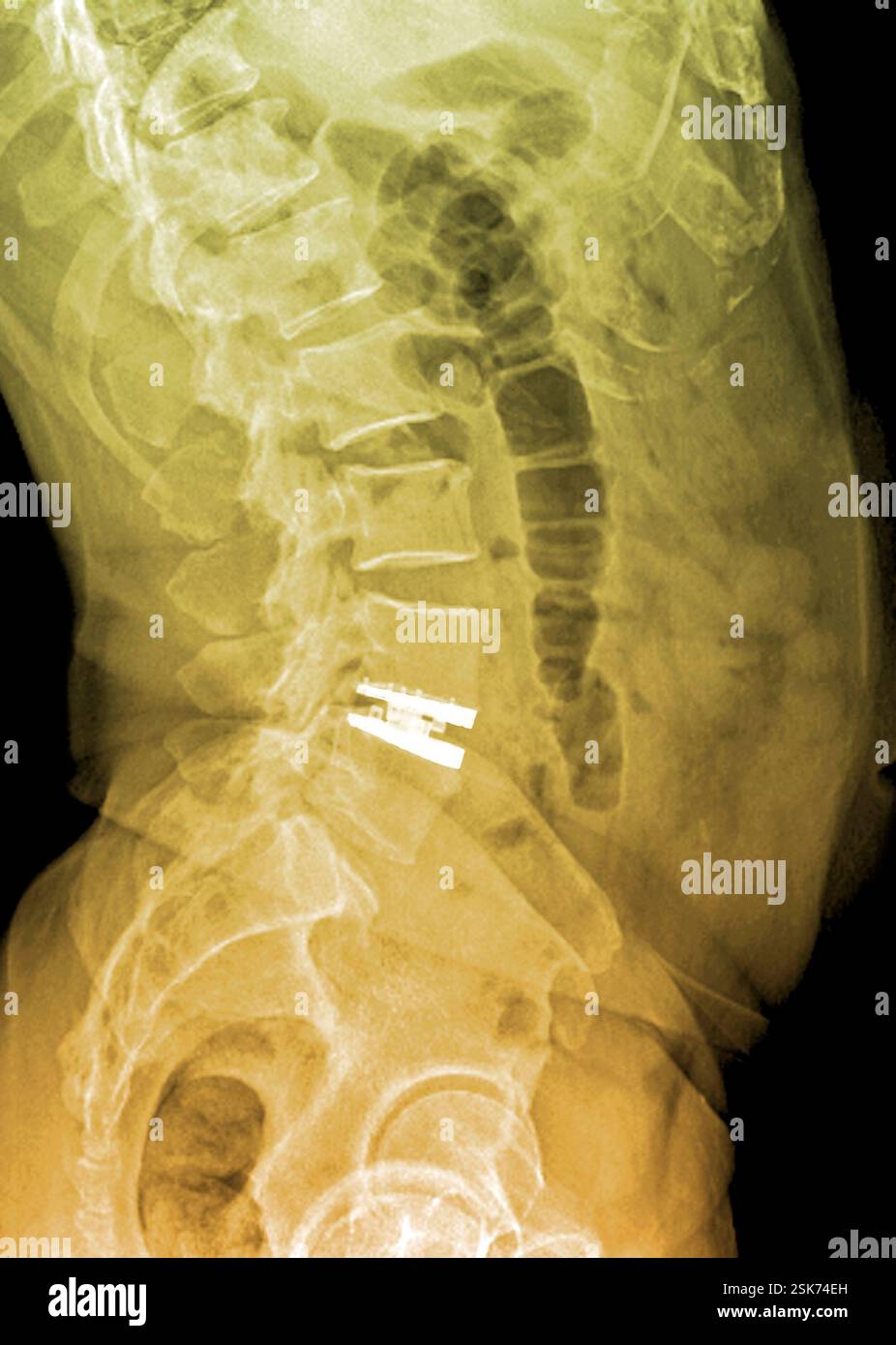 Lumbar spine disc implant. Coloured X-ray showing a side view of the ...