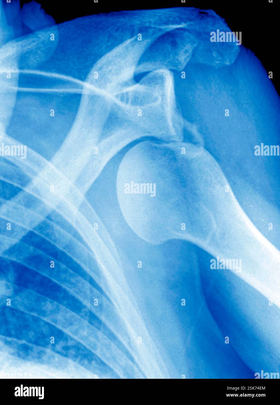 Dislocated shoulder. Coloured X-ray of the dislocated left shoulder of ...