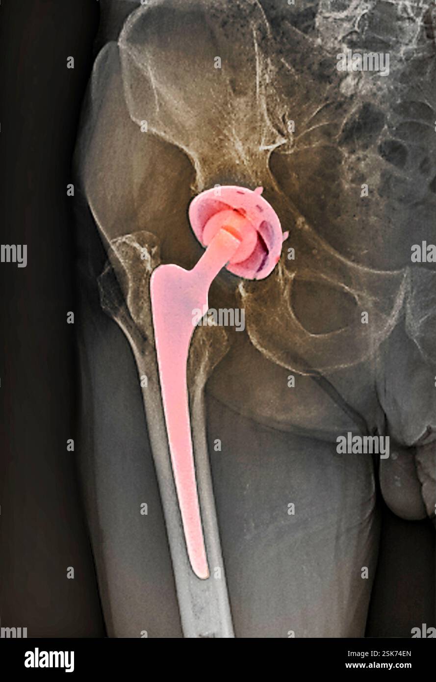 Total hip replacement. Coloured X-ray of a 70 year old woman's right ...