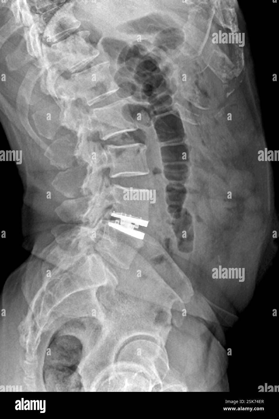 Lumbar spine disc implant. X-ray showing a side view of the lumbosacral ...