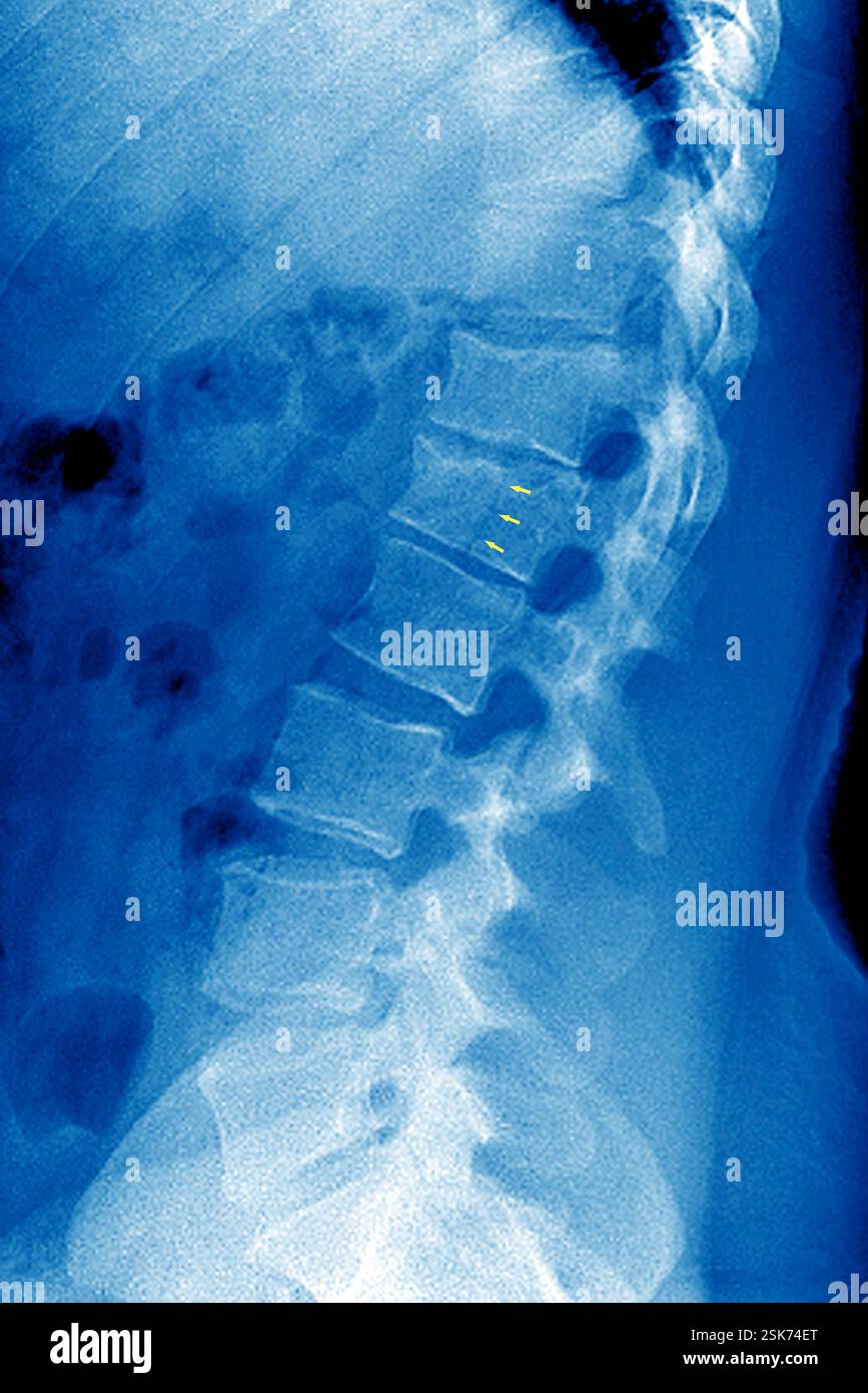 Spinal fracture. Coloured X-ray of the side view of the lumbar and ...