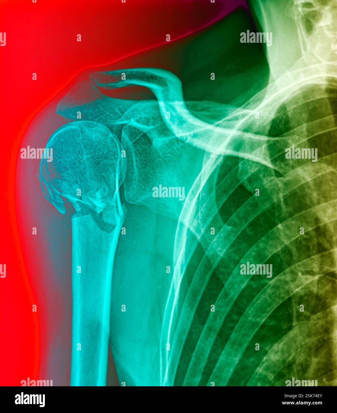 Broken arm. Coloured X-ray of the broken right arm of a 50 year old ...
