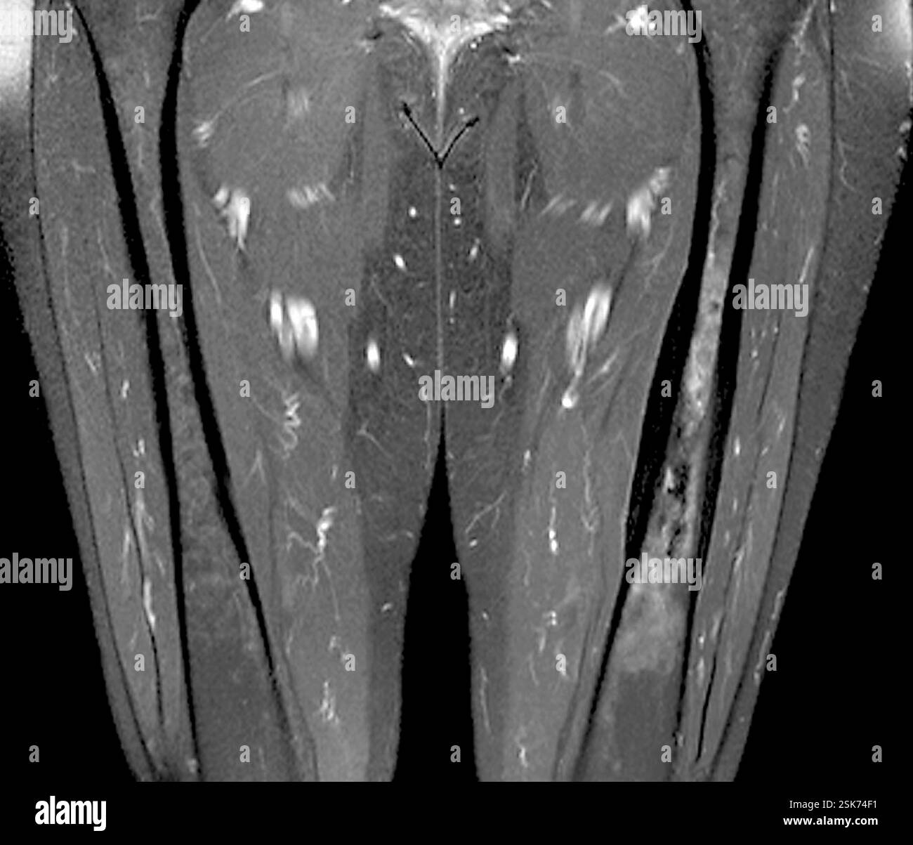 Bone infection. Magnetic resonance imaging (MRI) scan of the legs of a ...