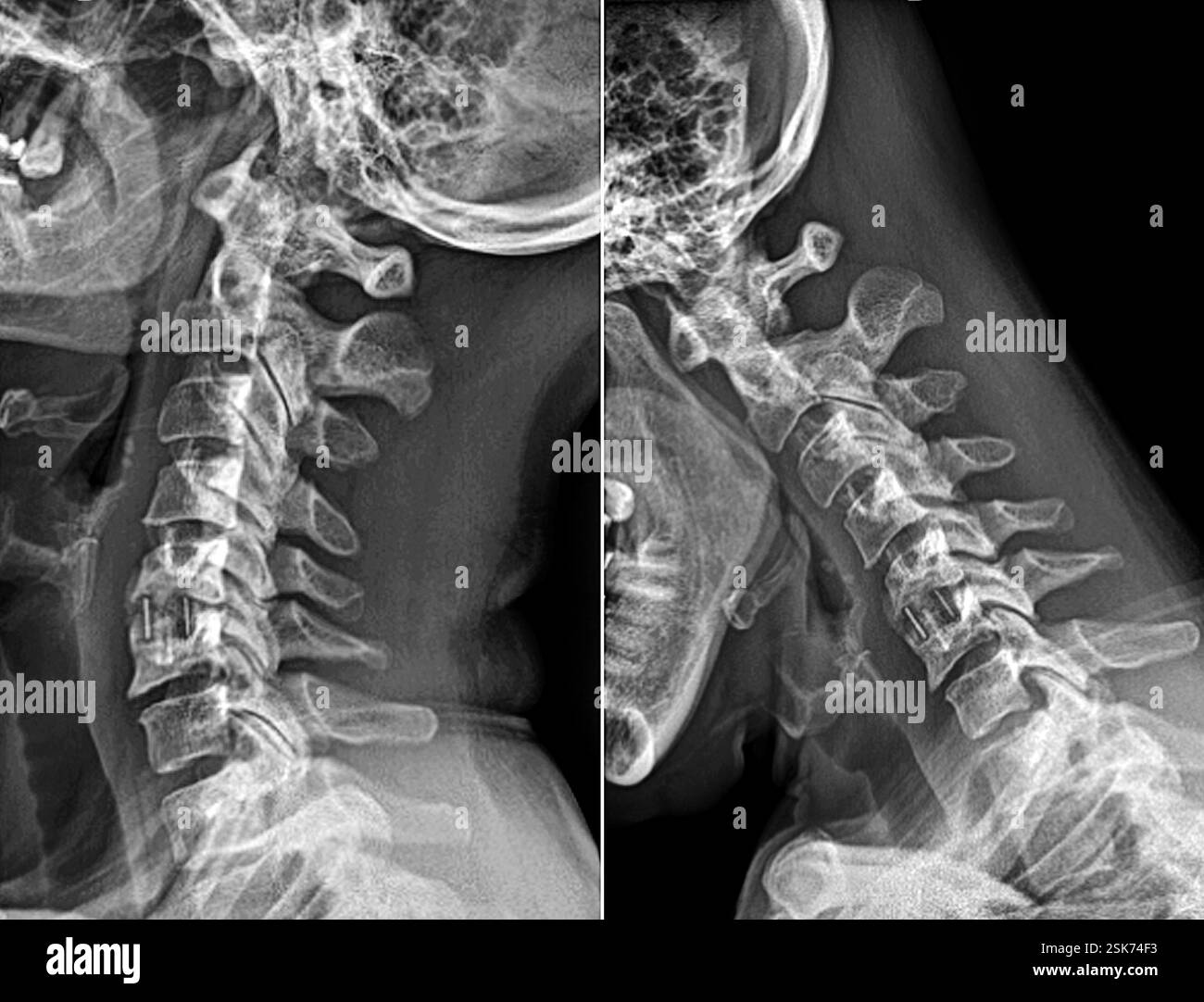 Bone graft in the neck. X-rays showing the cervical spine of a 51 year ...