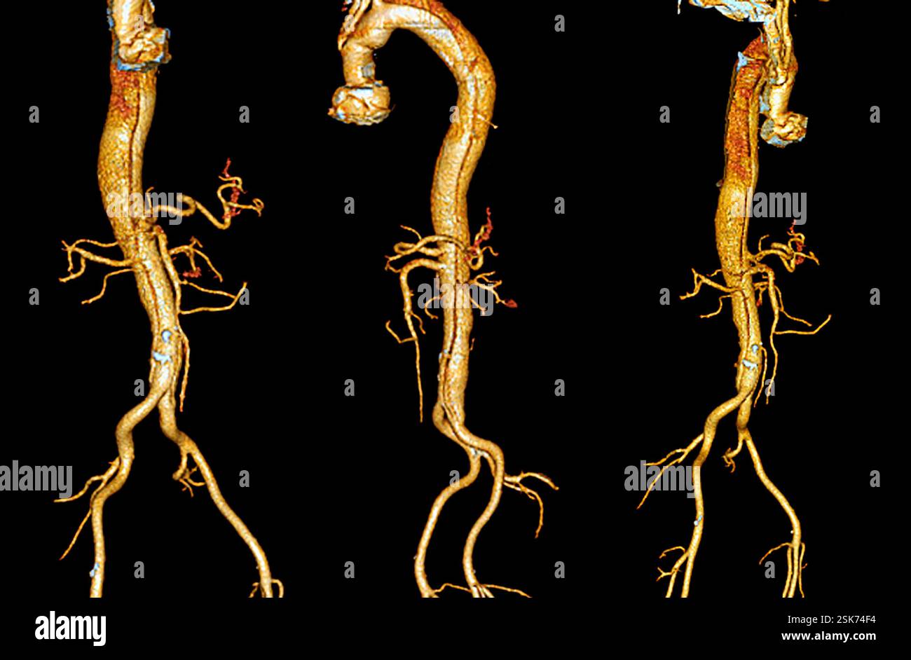 Dissecting aorta. Coloured three-dimensional (3D) Angiography Computed Tomography (CT) scans of ...
