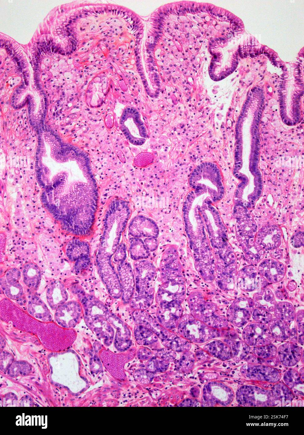 Light micrograph of human stomach lining showing gastric xanthelasma. Gastric xanthelasma ...