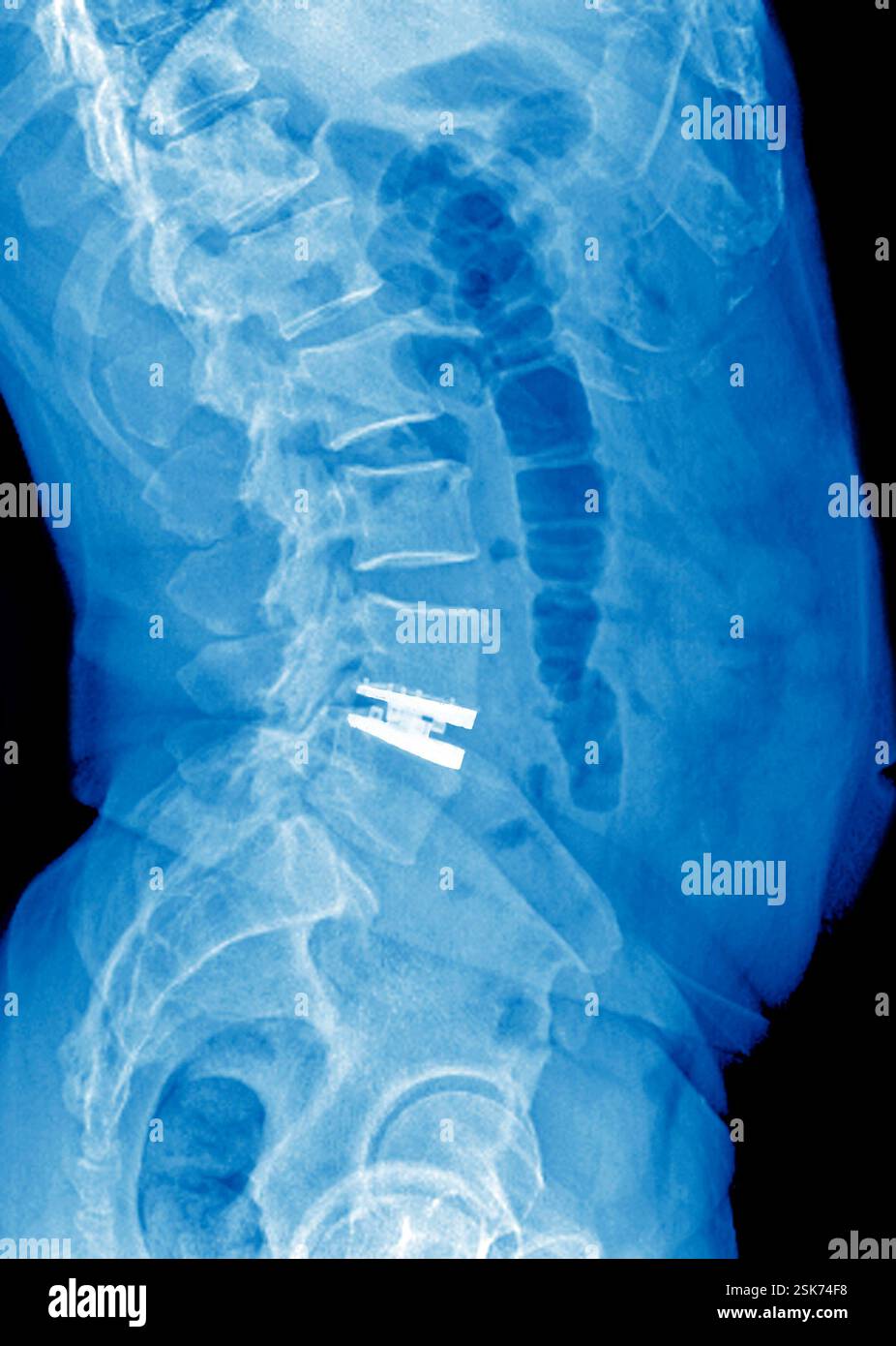 Lumbar spine disc implant. Coloured X-ray showing a side view of the ...