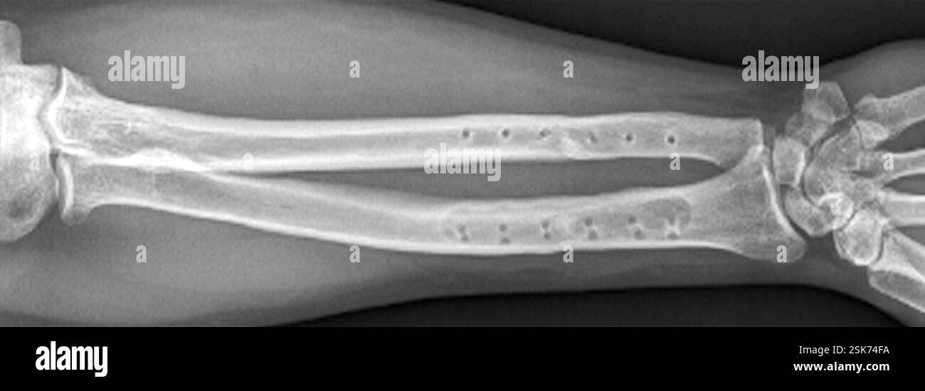 Healed broken arm. X-ray of the healed broken arm of a 29 year old male ...