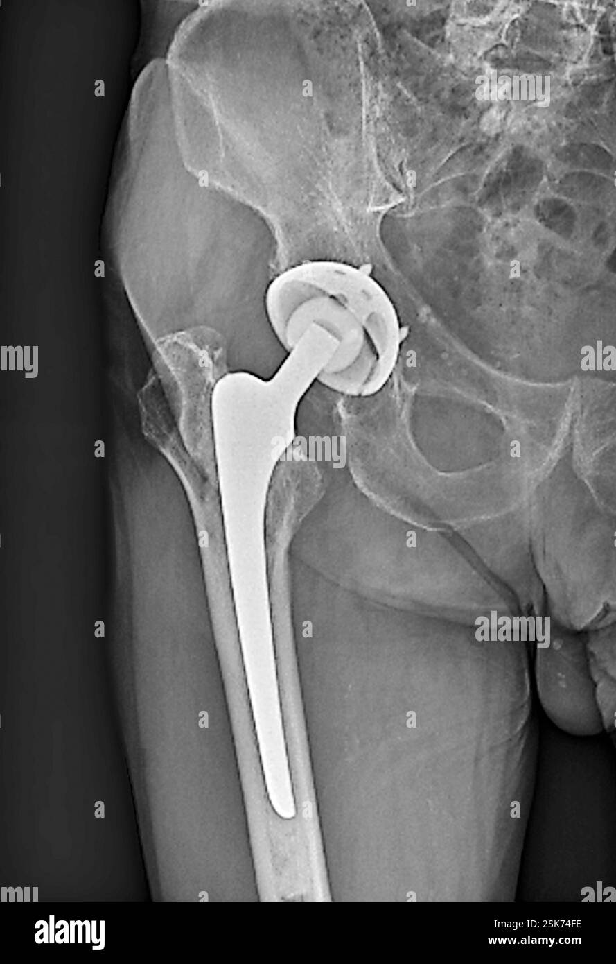 Total hip replacement. X-ray of a 70 year old woman's right hip ...