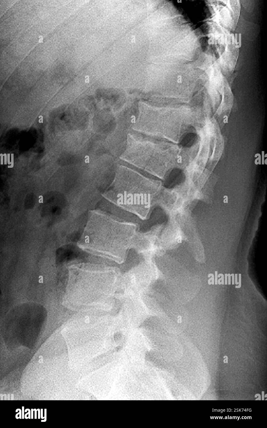 Spinal fracture. X-ray of the side view of the lumbar and thoracic spine of a 25 year old male ...