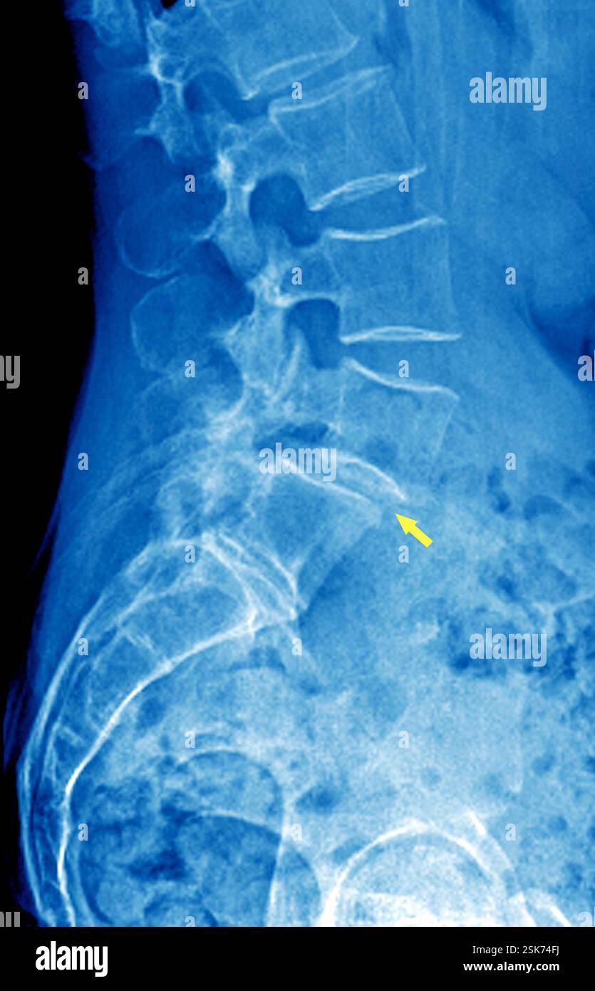 Spondylolisthesis. Coloured X-ray side view of the lower back of a 58 ...