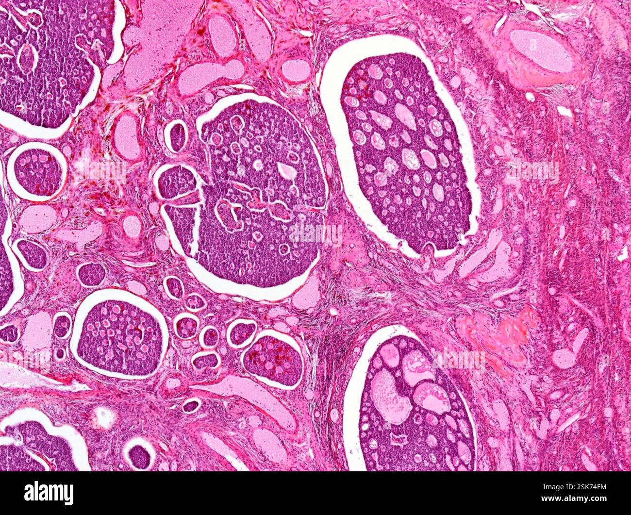 Miliary tuberculosis, CT scan Stock Photo - Alamy