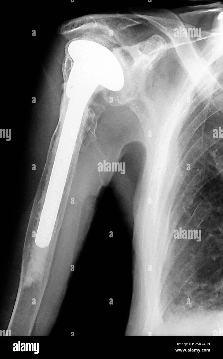 Artificial shoulder. X-ray of an artificial (prosthetic) right shoulder ...