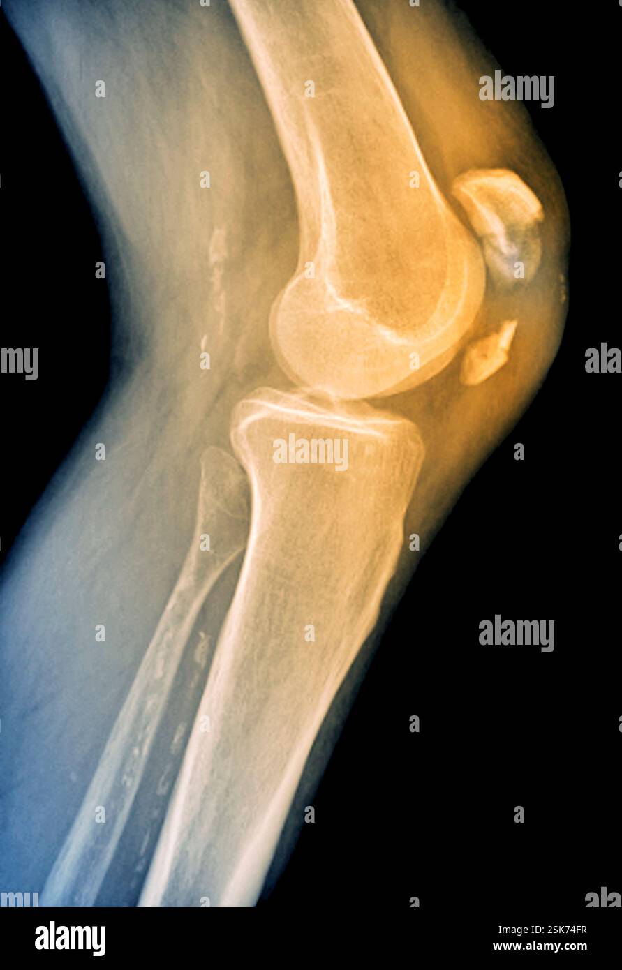 Fractured patella (kneecap). Coloured X-ray showing a side view of the ...
