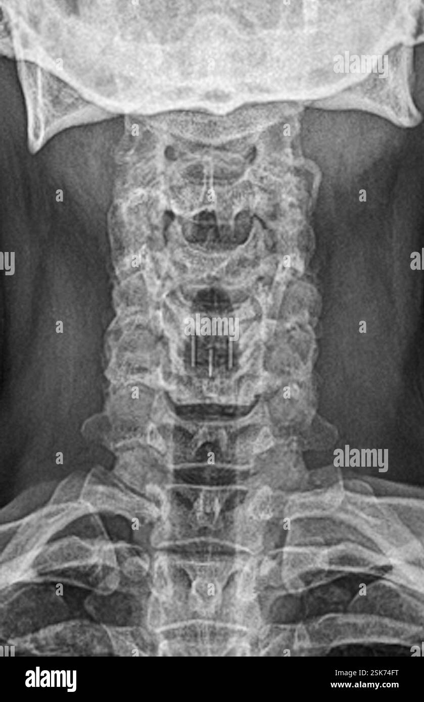 Bone graft in the neck. X-ray showing the cervical spine of a 51 year ...