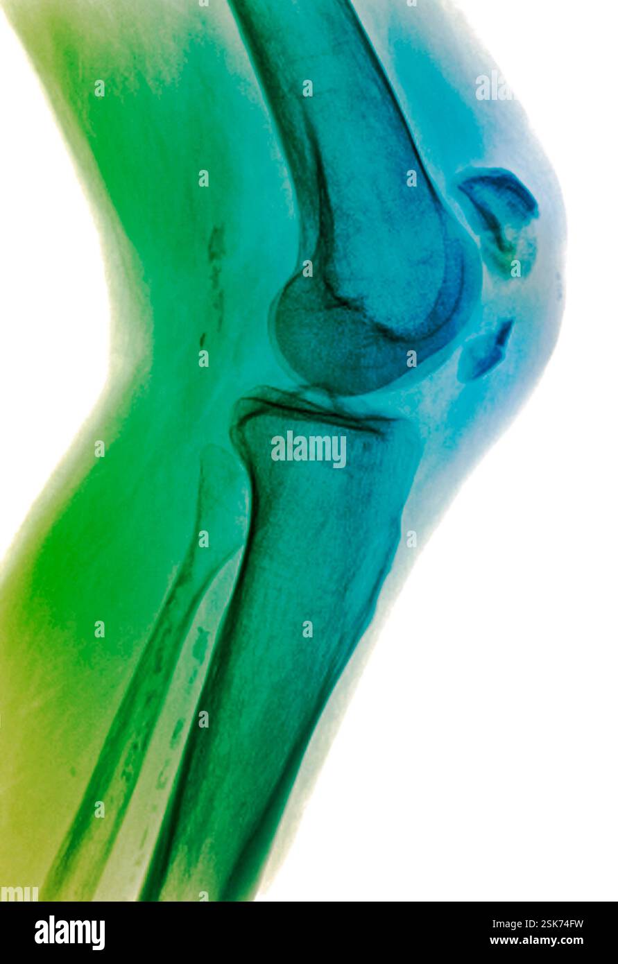 Fractured patella (kneecap). Coloured X-ray showing a side view of the ...
