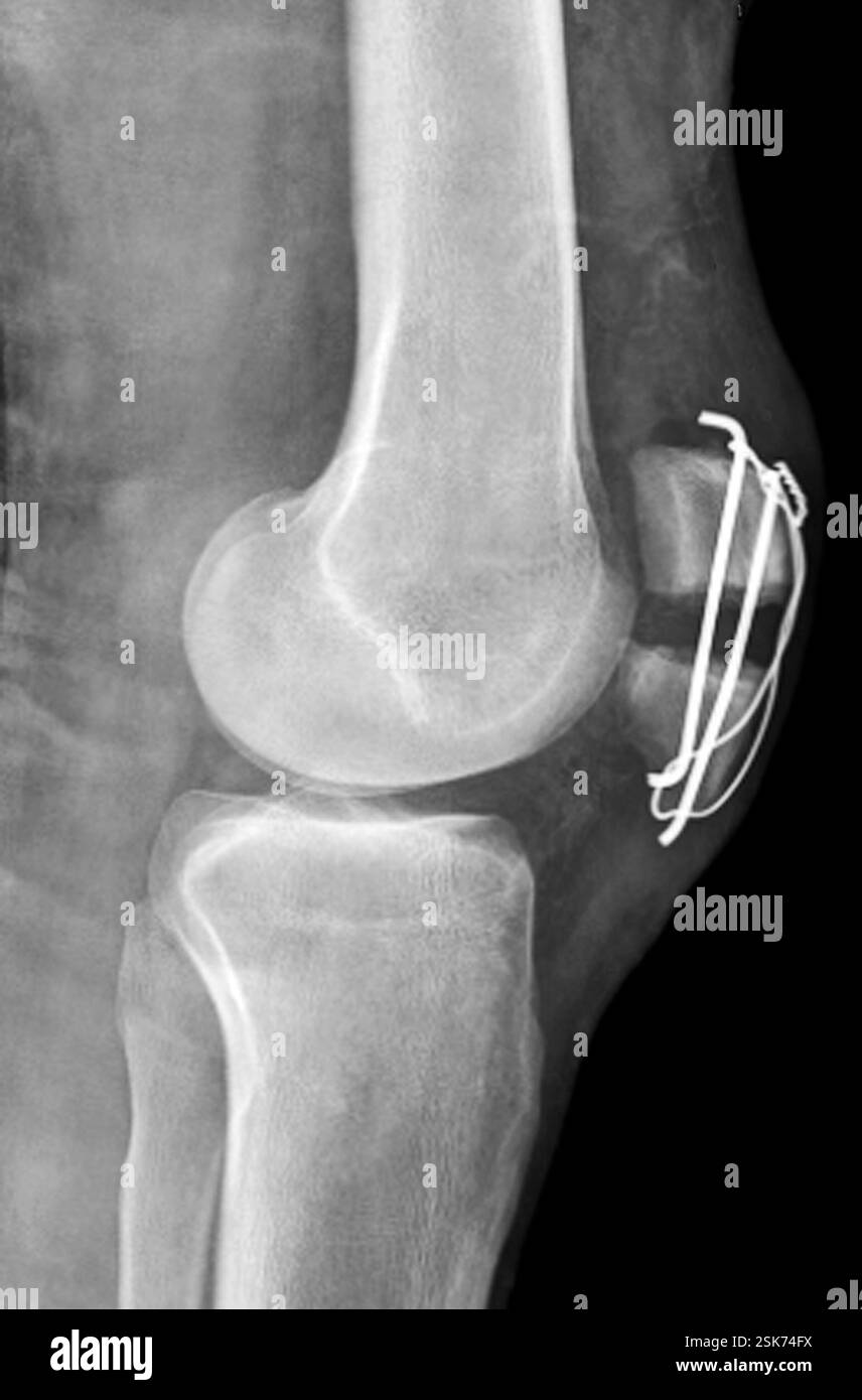 Pinned kneecap fracture. X-ray of a side view of the pinned fractured ...