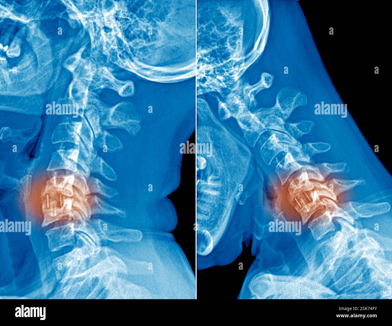 Bone graft in the neck. Coloured X-rays showing the cervical spine of a ...