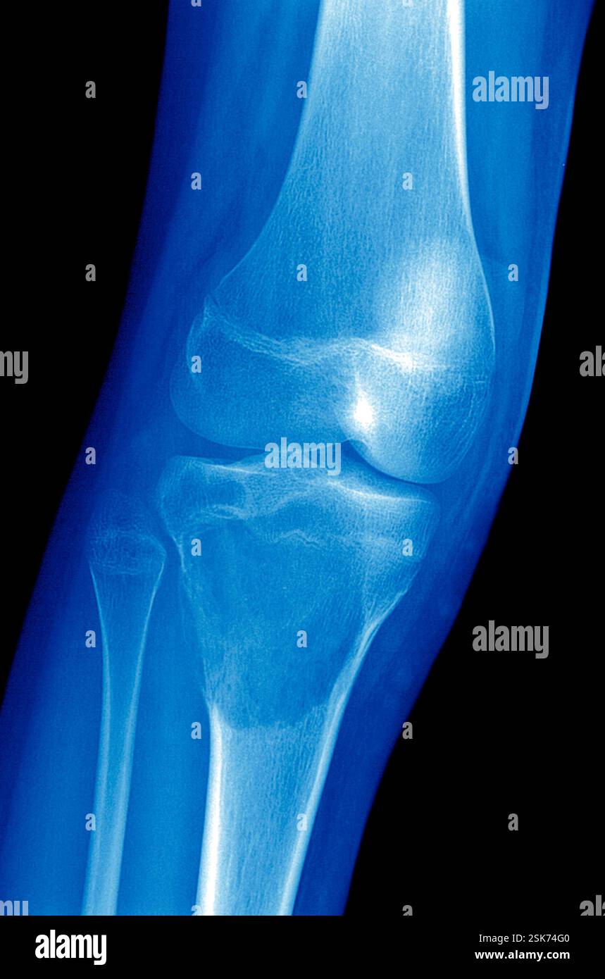 Bone tumour. Coloured X ray showing a tumour of the upper part of the ...