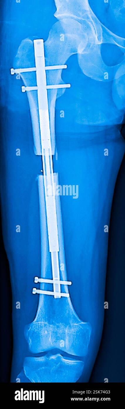 Distraction osteogenesis (bone lengthening). Coloured X-ray showing the ...