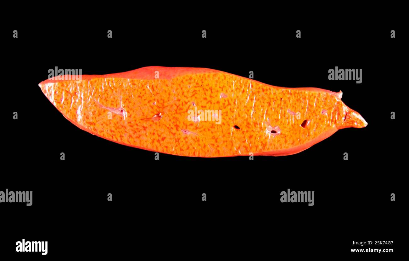 Fatty liver. Gross specimen of a sectioned liver with steatosis (fatty ...