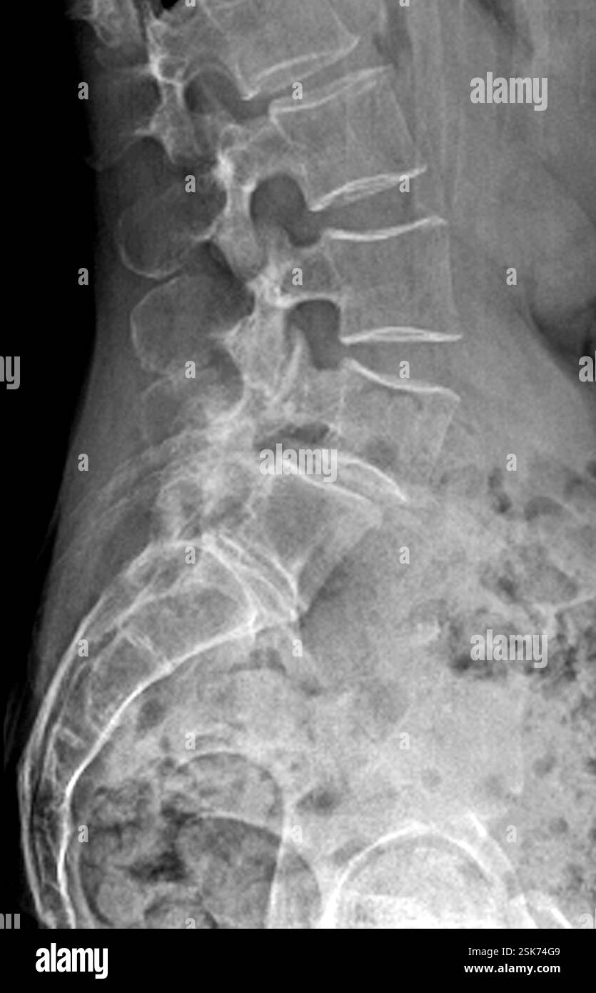 Spondylolisthesis. X-ray side view of the lower back of a 58 year old ...