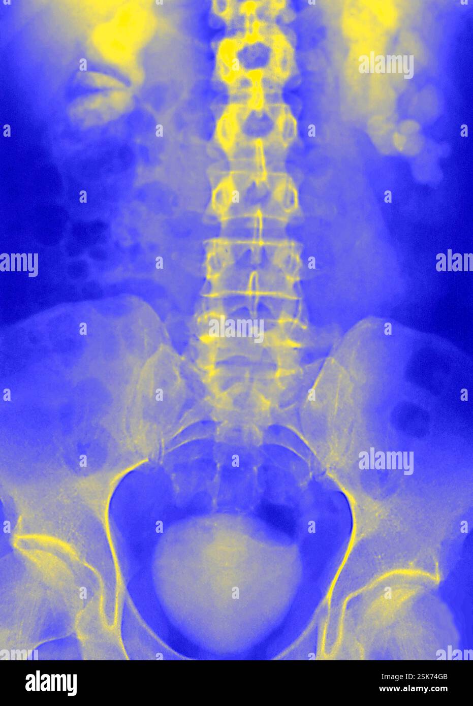 Swollen kidneys. X-ray of the abdomen of a 50 year old man with a ...