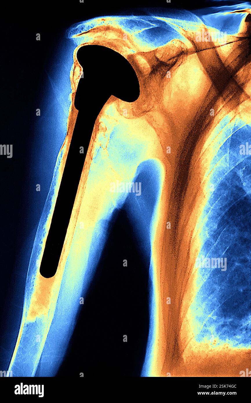Artificial shoulder. Coloured X-ray of an artificial (prosthetic) right ...