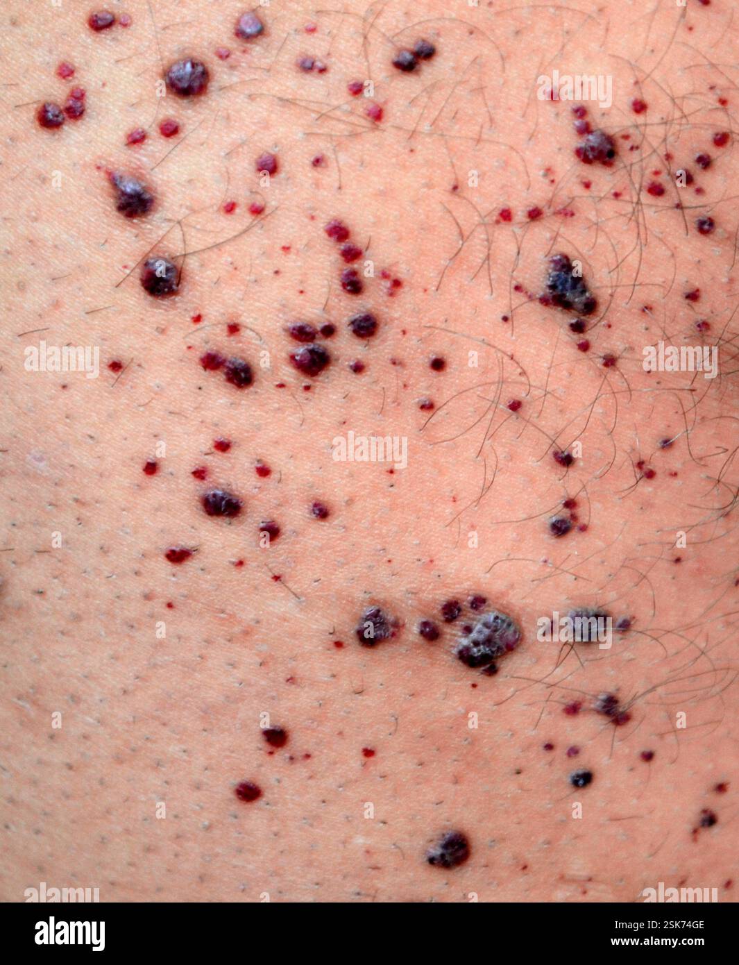 Fabry's disease. Close-up of angiokeratomas on the skin of a 30-year ...