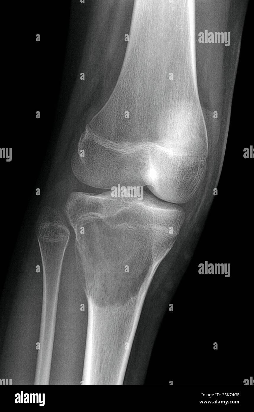 Bone tumour. X ray showing a tumour of the upper part of the tibia ...