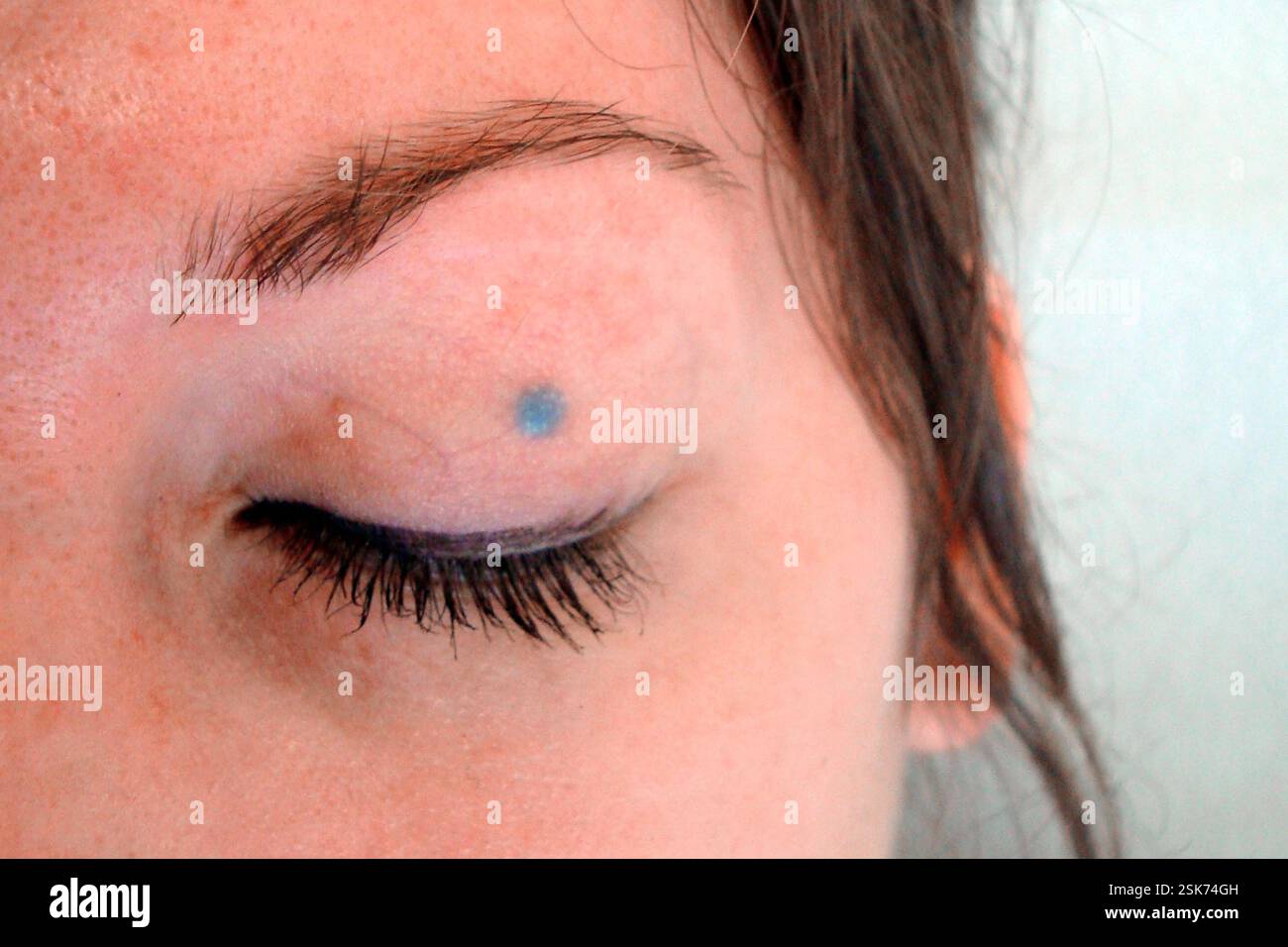 Nevus. Blue nevus on the left upper eyelid of a 19-year-old female ...