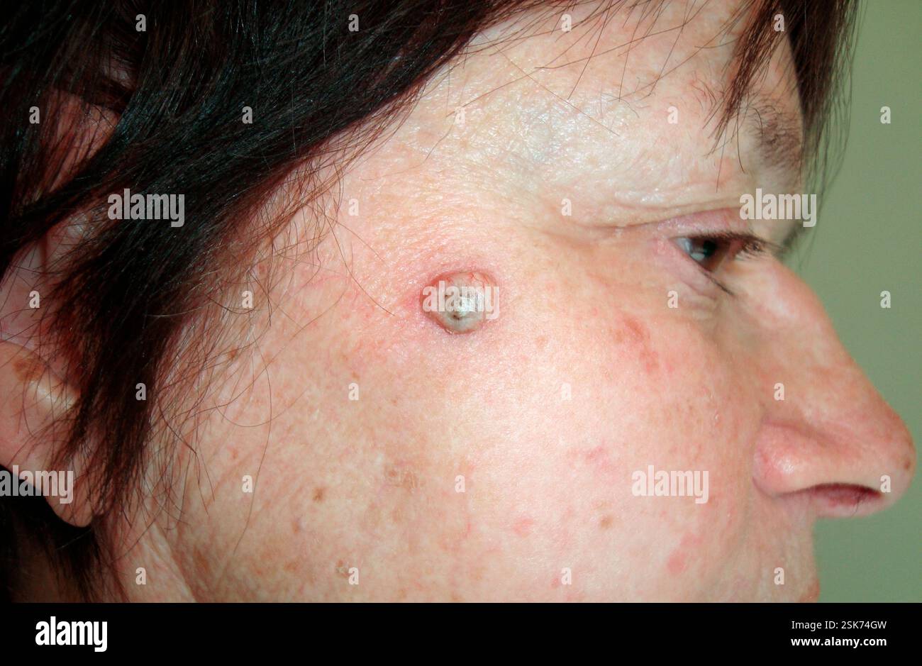 Skin cancer. Close-up of squamous cell carcinoma (SCC, skin cancer) on ...