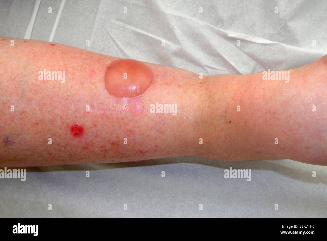 Bullous pemphigoid. Blister on the leg of a 75-year-old female patient ...