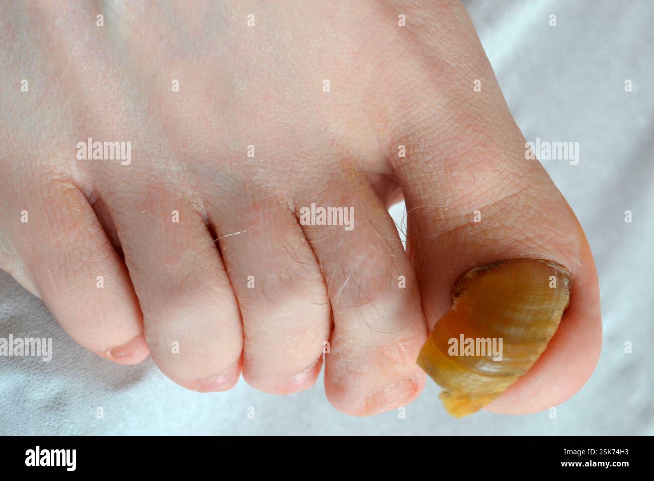 Deformed toenail. Close-up of the foot of a 33-year-old female patient ...