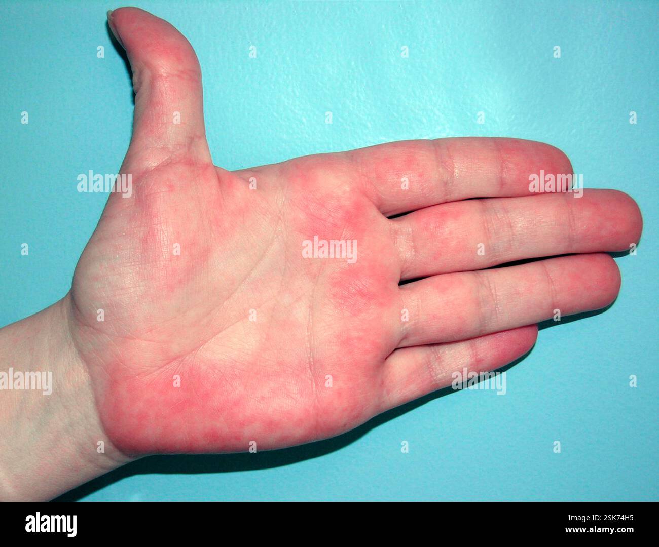 Lane's disease. Hand of a 33-year-old female patient with Lane's ...