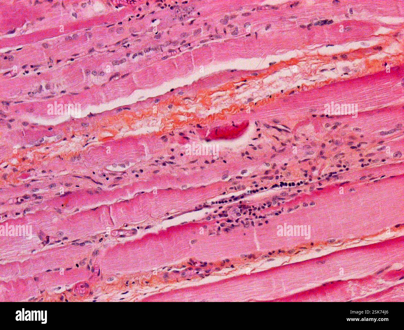 Inflamed muscle tissue. Light micrograph of a longitudinal section ...