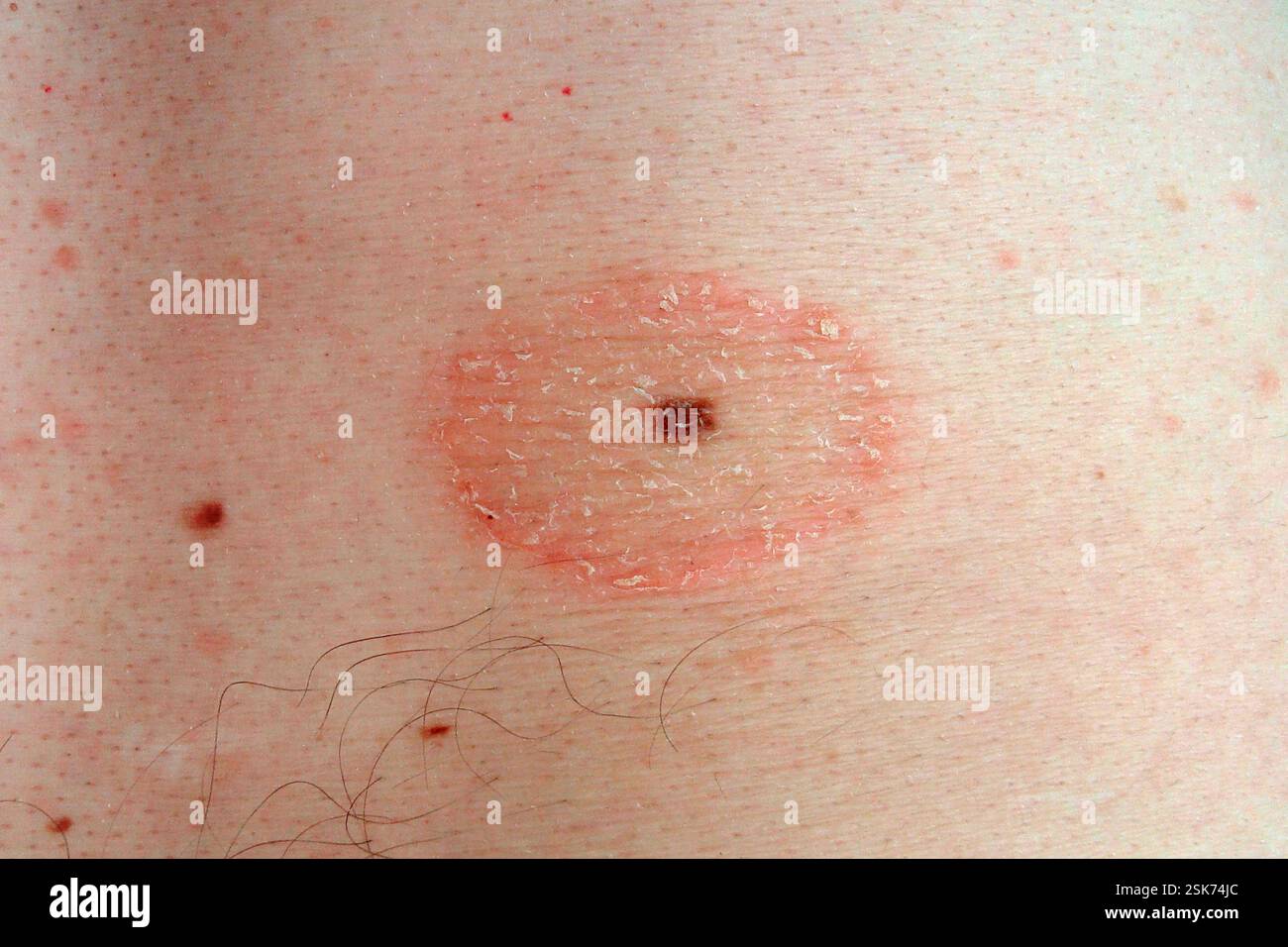 Meyerson's nevus. Close-up of a Meyerson's nevus on the back of a 42 ...