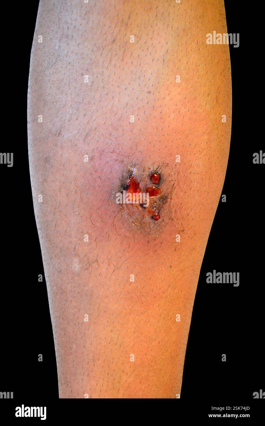Pyoderma gangrenosum. Close-up of ulcers on the leg of a 38-year-old male patient with pyoderma ...