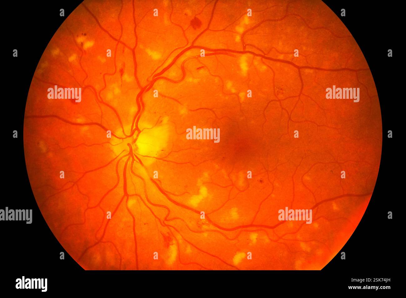 Diabetic retinopathy, fundus photograph. View of the interior surface ...