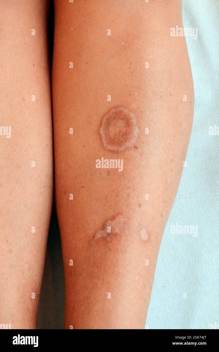 Diabetic skin lesions. Close-up of lesions on the leg of a 60-year-old ...