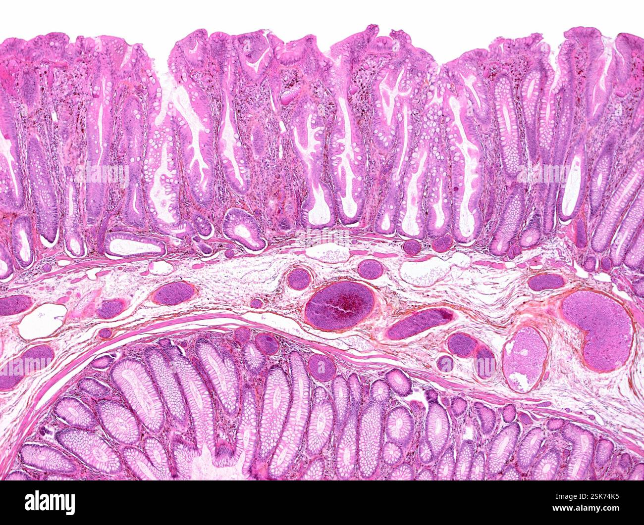 Sessile serrated adenoma of the colon. Light micrograph of a section ...