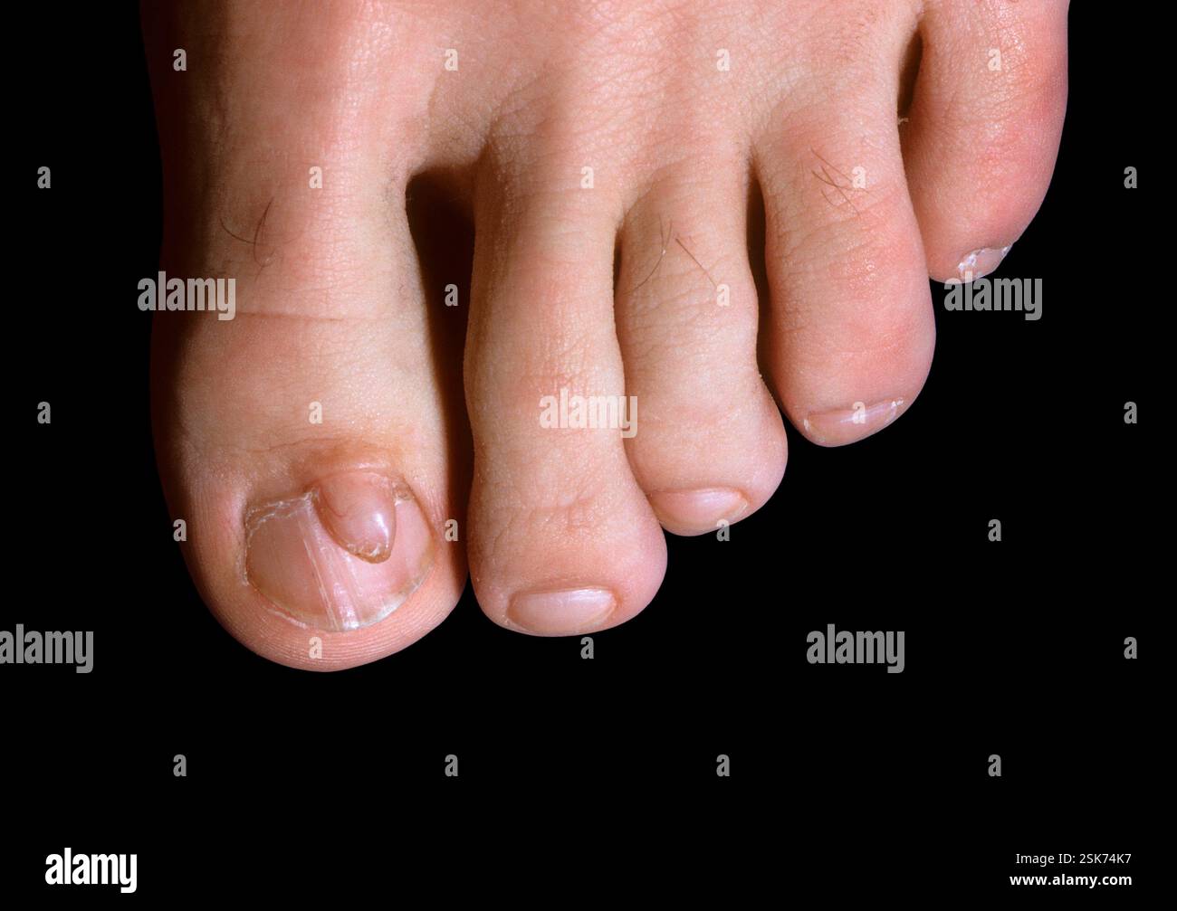 Koenen's tumour. Close-up of the foot of a 35-year-old male patient ...
