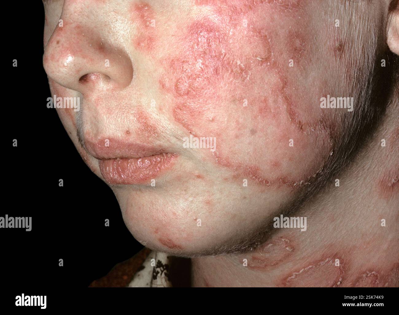 Lupus erythematosus. Close-up of a rash on the face and neck of a 35 ...